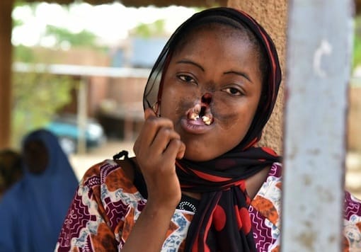 Cutar Noma | Bakandamiya